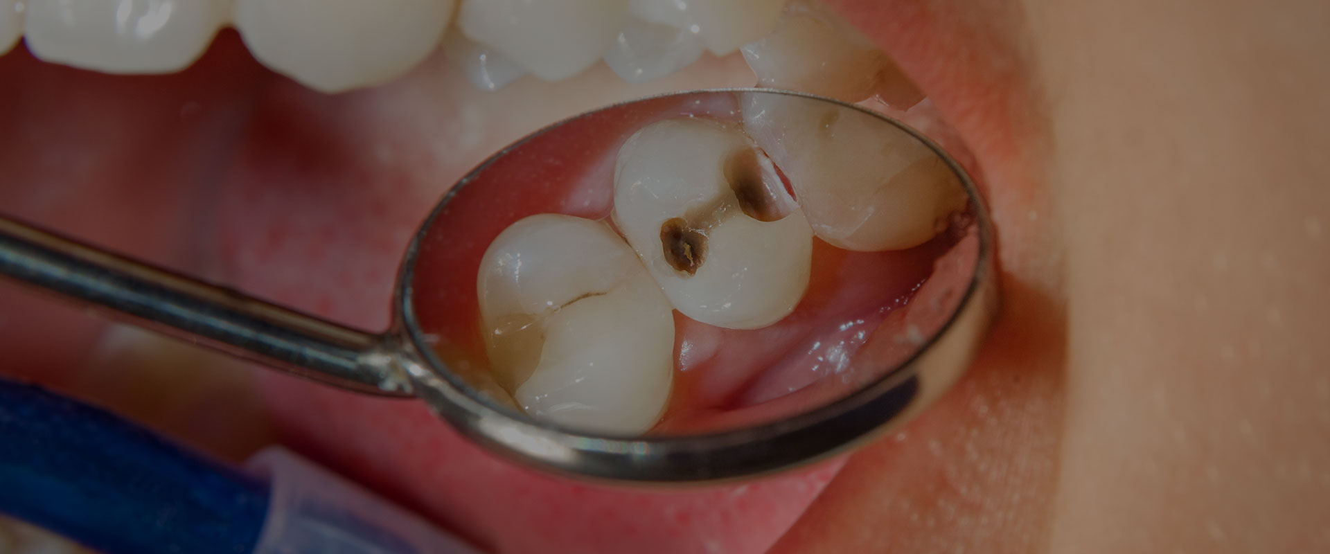 7 Signs of Tooth Decay | La Mesa, CA |Cardinal Dental